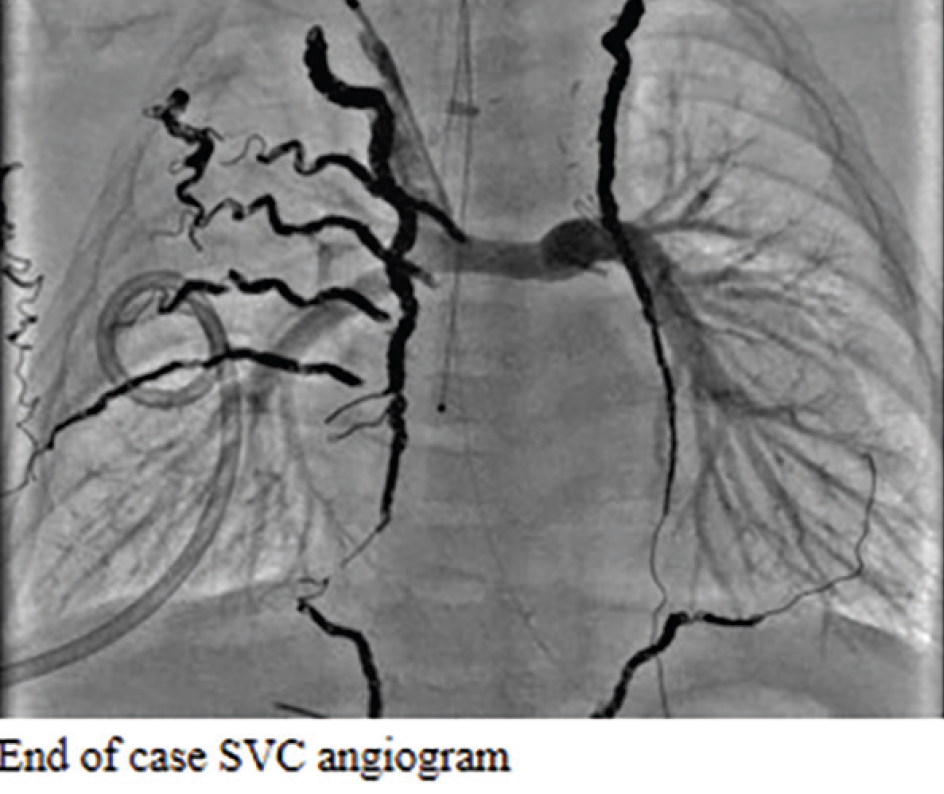 Penumbra Peripheral Embolization System: A Decade of Innovation in ...