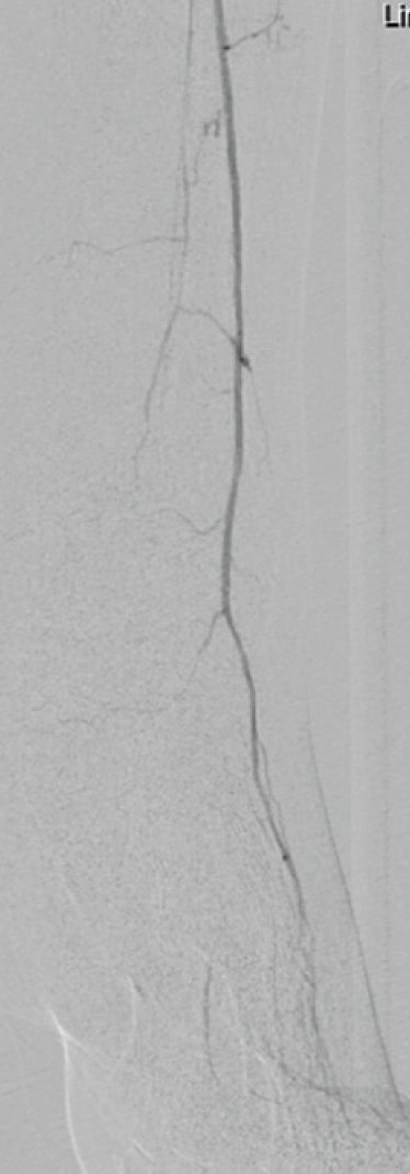 Shape Memory Polymer: A New Solution for AAA Endoleak Management ...