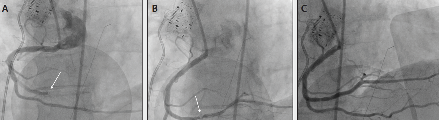 New Evidence Supports Continuous Power Aspiration With Indigo® System ...