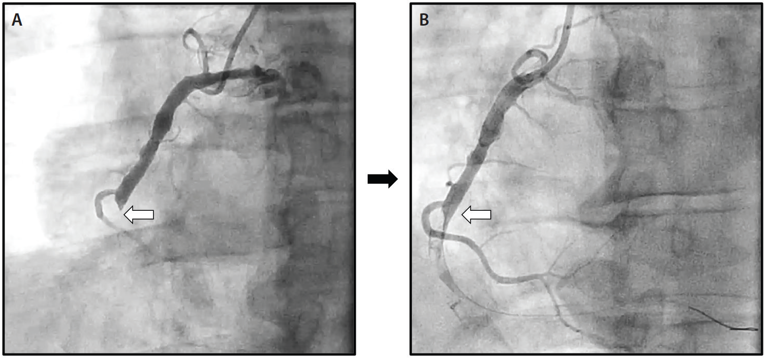 New Evidence Supports Continuous Power Aspiration With Indigo® System ...