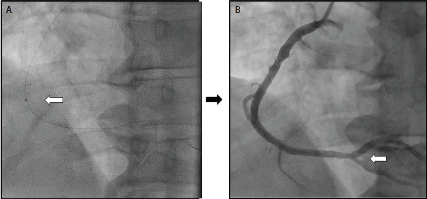 New Evidence Supports Continuous Power Aspiration With Indigo® System ...