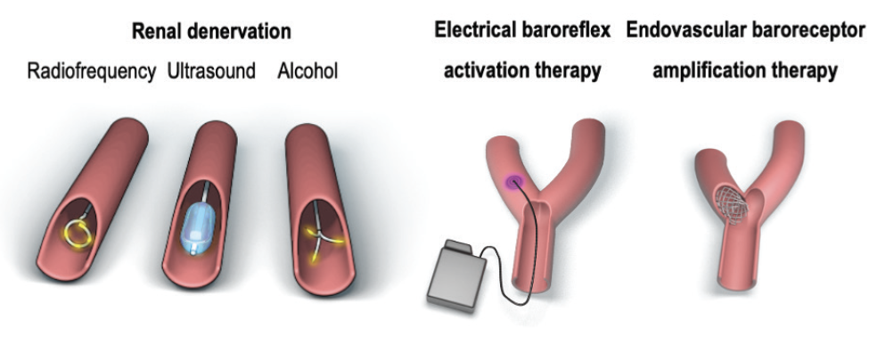 Neuromodulation in Heart Failure: Proven and Emerging Solutions ...