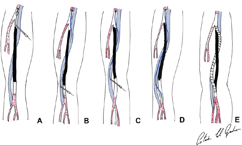 Extra-Anatomic Solutions for Long SFA Occlusions in CLI - Endovascular ...