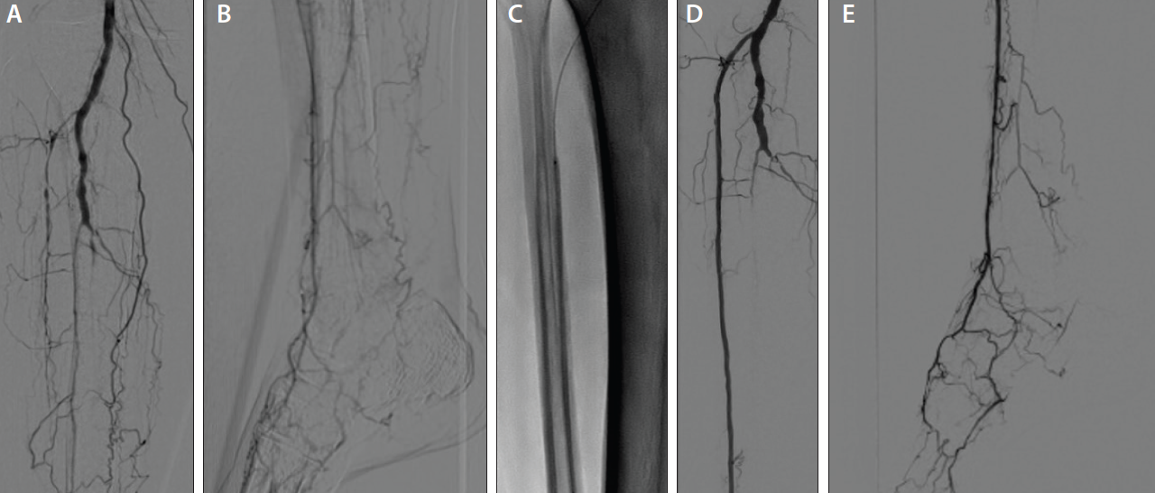 Serrate and Inflate: Treating CLTI Using the Serranator® PTA Serration ...