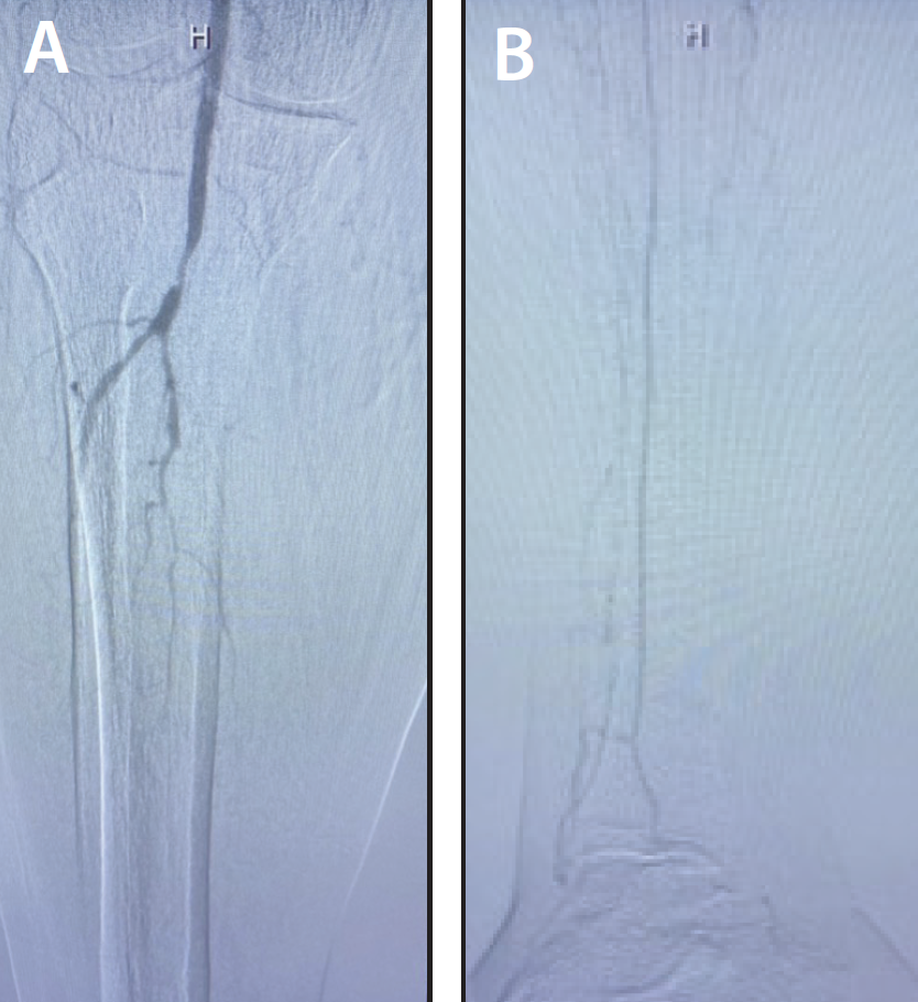 Serrate and Inflate: Treating CLTI Using the Serranator® PTA Serration ...