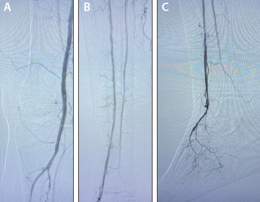 Serrate and Inflate: Treating CLTI Using the Serranator® PTA Serration ...