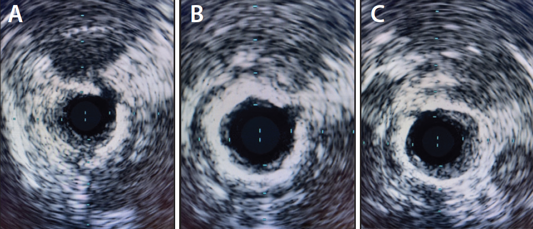 Serrate and Inflate: Treating CLTI Using the Serranator® PTA Serration ...