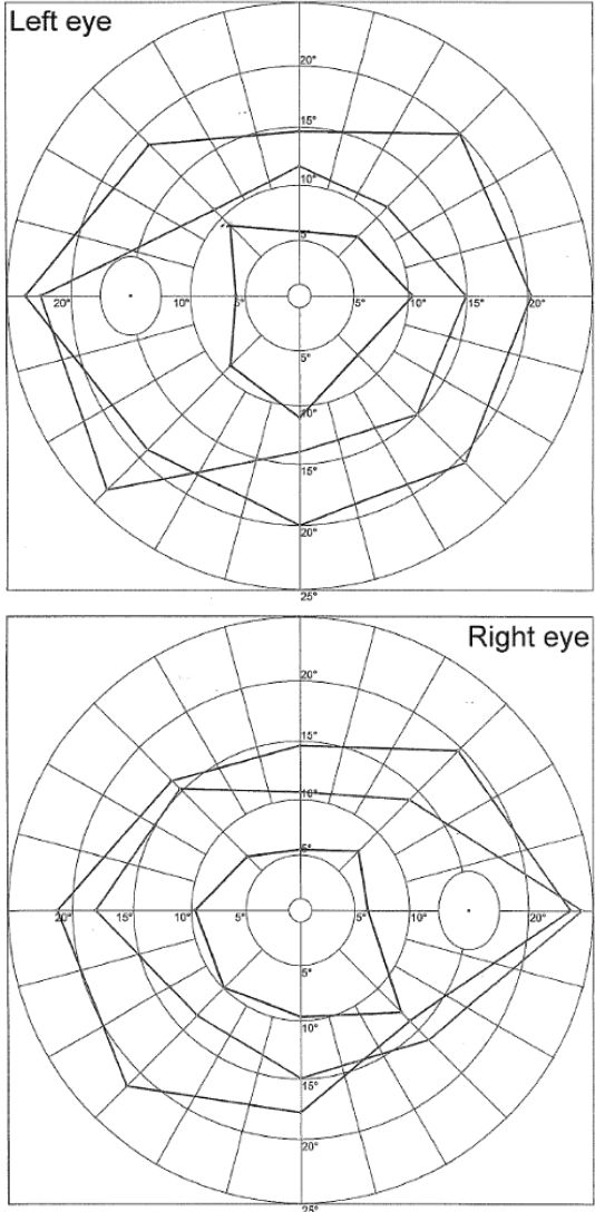 Visual Consequences of Mild Traumatic Brain Injury - Modern Optometry