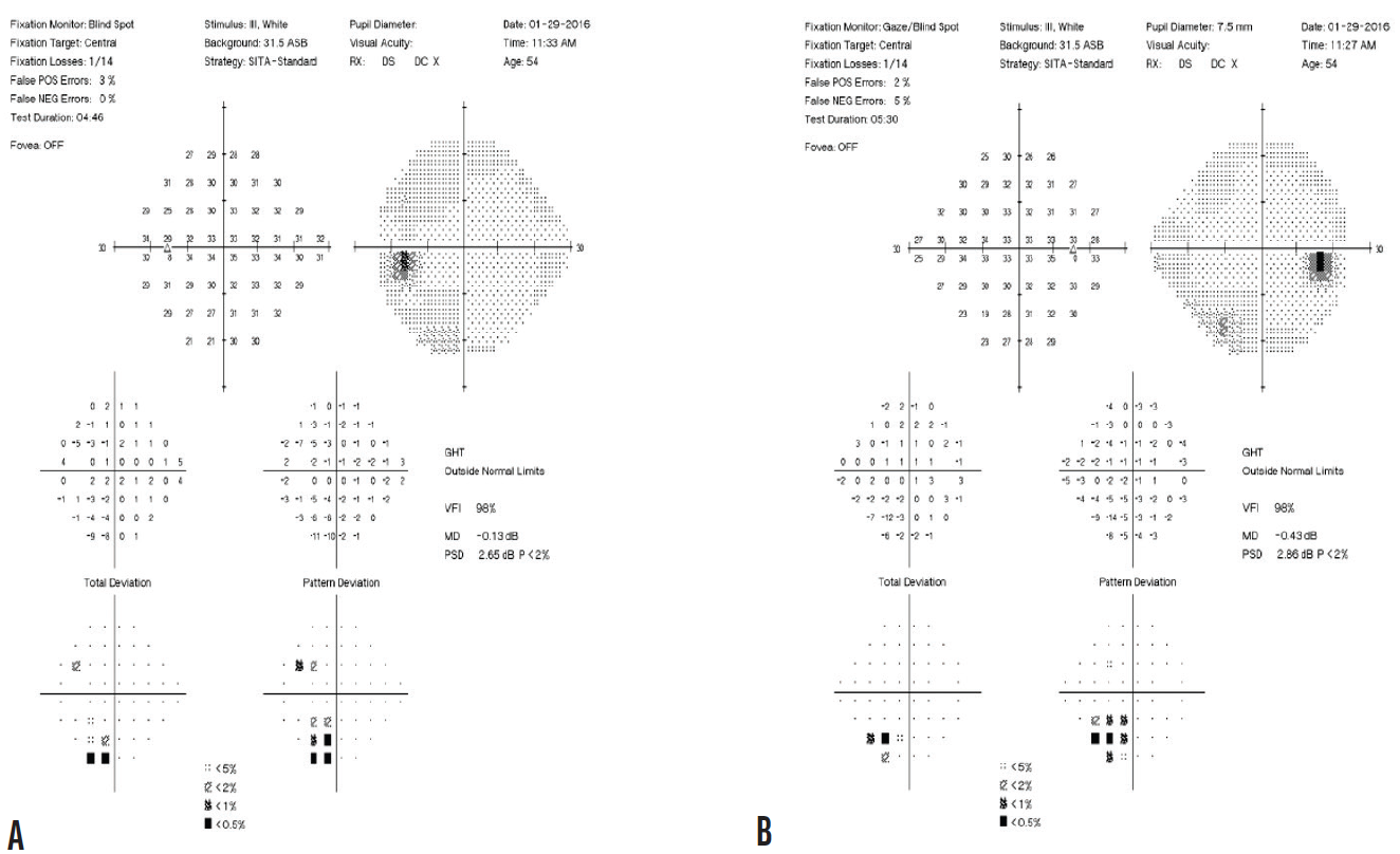 Glioblastoma Multiforme - Modern Optometry