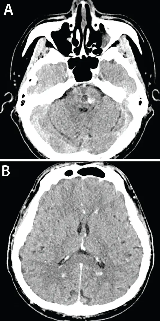 Cerebral Cavernous Malformation 🧠 **Understanding Cavernous