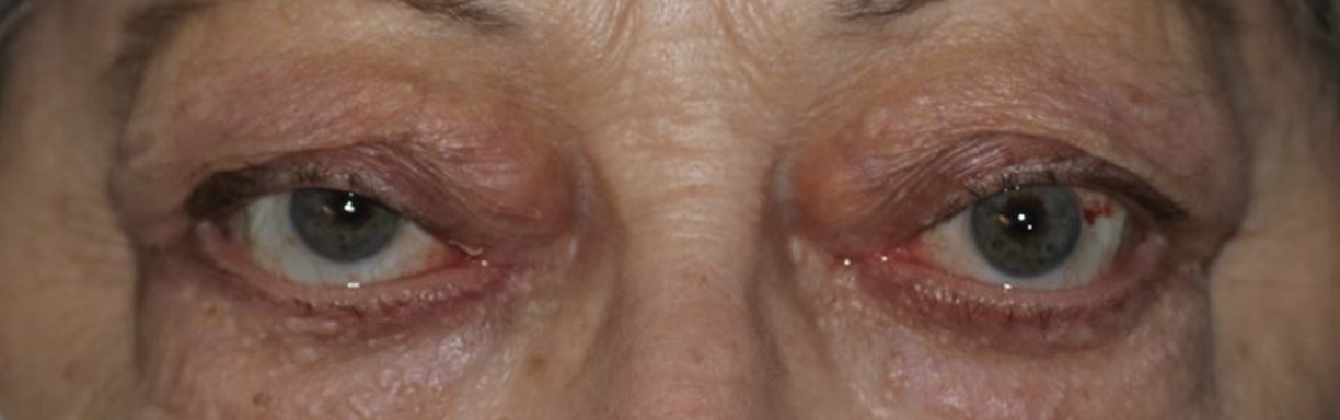 What You Need to Know to Manage TED - Modern Optometry