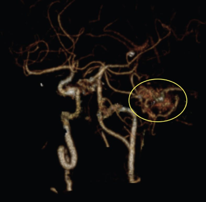 Foville Syndrome Associated With Cerebellar Arteriovenous Malformation ...
