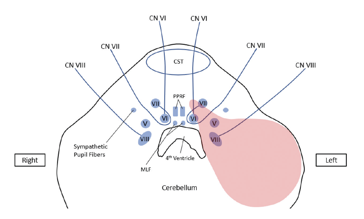 Foville Syndrome Associated With Cerebellar Arteriovenous Malformation ...