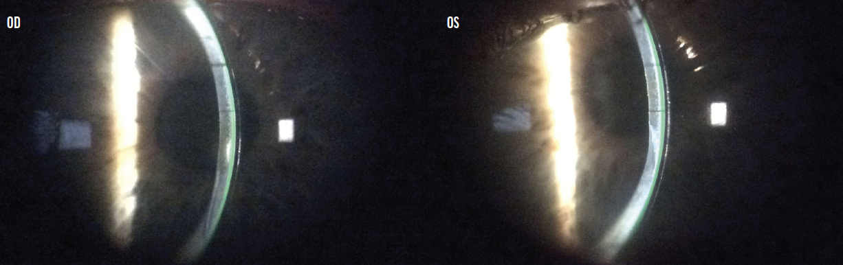 Radial Keratotomy Patients Keep Things Interesting - Modern Optometry