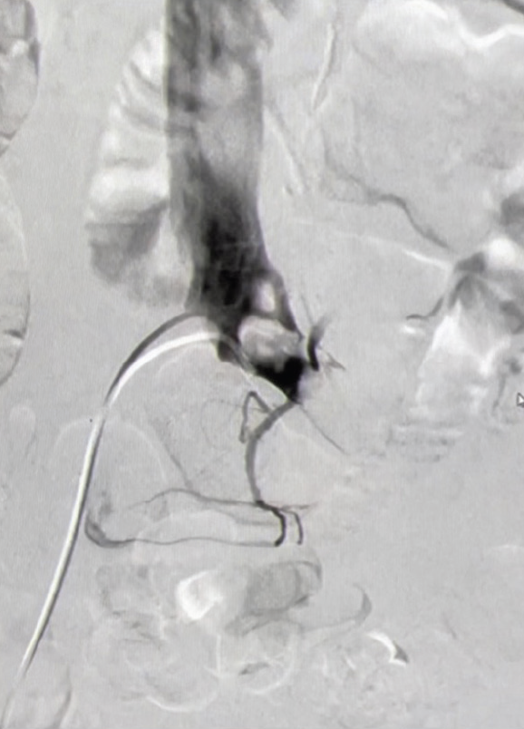 Penumbra’s Indigo™ System With Lightning™ Intelligent Aspiration ...