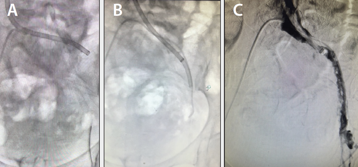 Penumbra’s Indigo™ System With Lightning™ Intelligent Aspiration ...