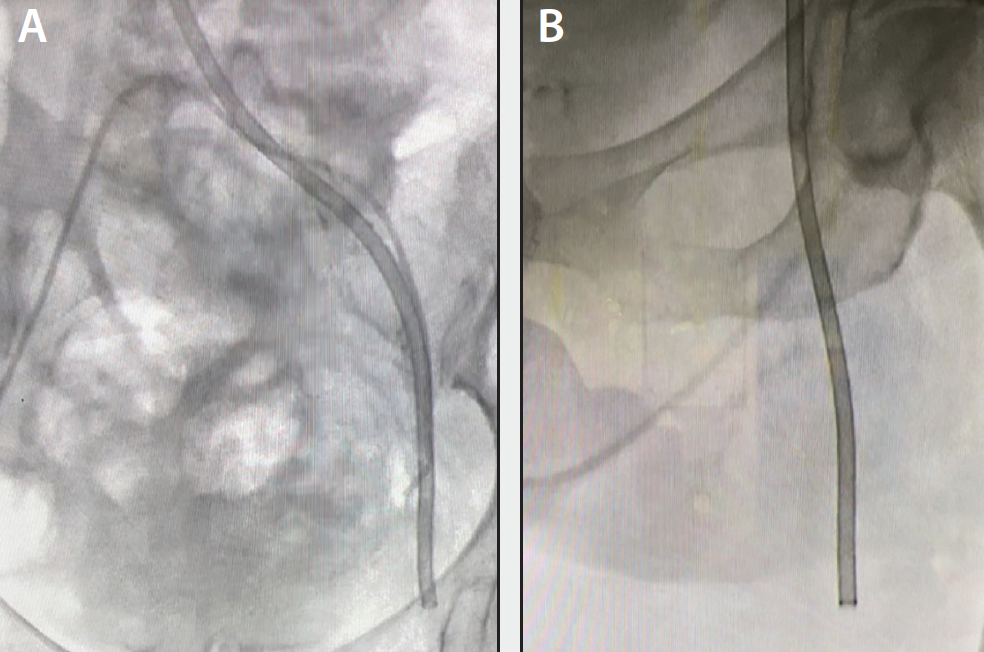 Penumbra’s Indigo™ System With Lightning™ Intelligent Aspiration ...