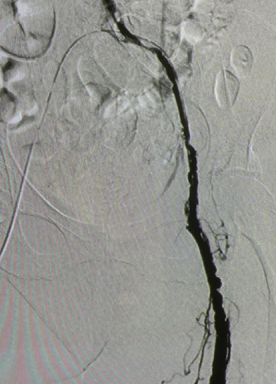 Penumbra’s Indigo™ System With Lightning™ Intelligent Aspiration ...