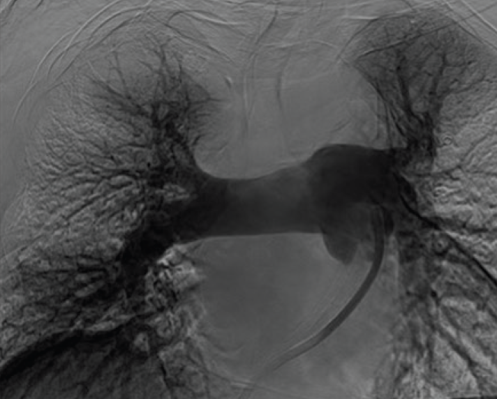 Penumbra’s Indigo™ System With Lightning™ Intelligent Aspiration ...