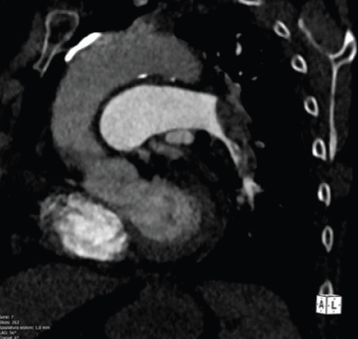 Penumbra’s Indigo™ System With Lightning™ Intelligent Aspiration ...