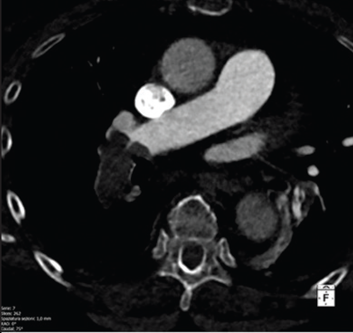 Penumbra’s Indigo™ System With Lightning™ Intelligent Aspiration ...