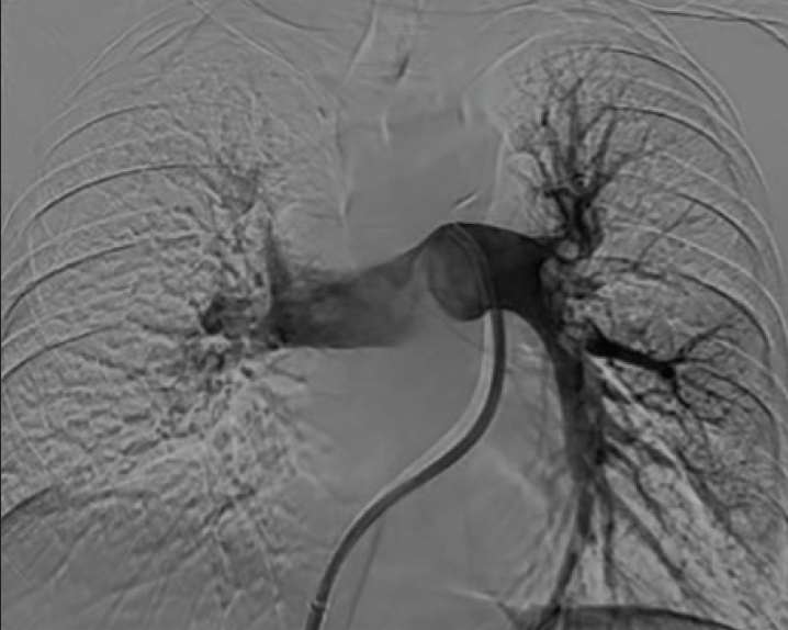 Penumbra’s Indigo™ System With Lightning™ Intelligent Aspiration ...