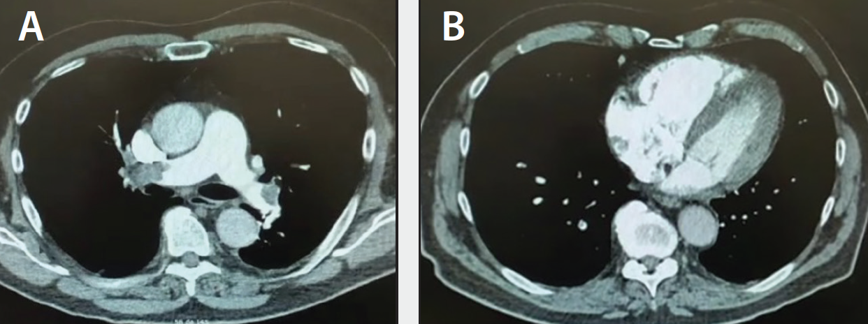 Penumbra’s Indigo™ System With Lightning™ Intelligent Aspiration ...