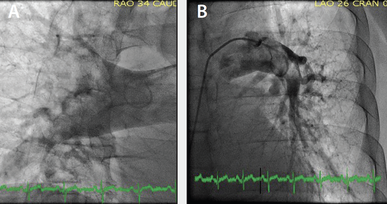 Penumbra’s Indigo™ System With Lightning™ Intelligent Aspiration ...