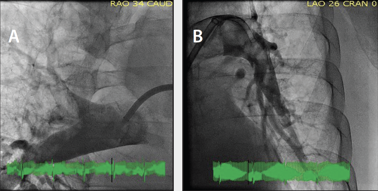 Penumbra’s Indigo™ System With Lightning™ Intelligent Aspiration ...