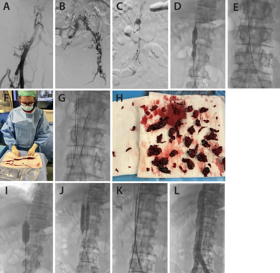 Patient Pathways: How the ClotTriever System Is Changing DVT Treatment at Two University ...