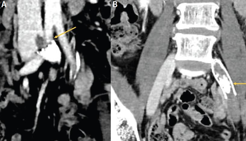 Venous Stent Failure in Postthrombotic Occlusions - Endovascular Today
