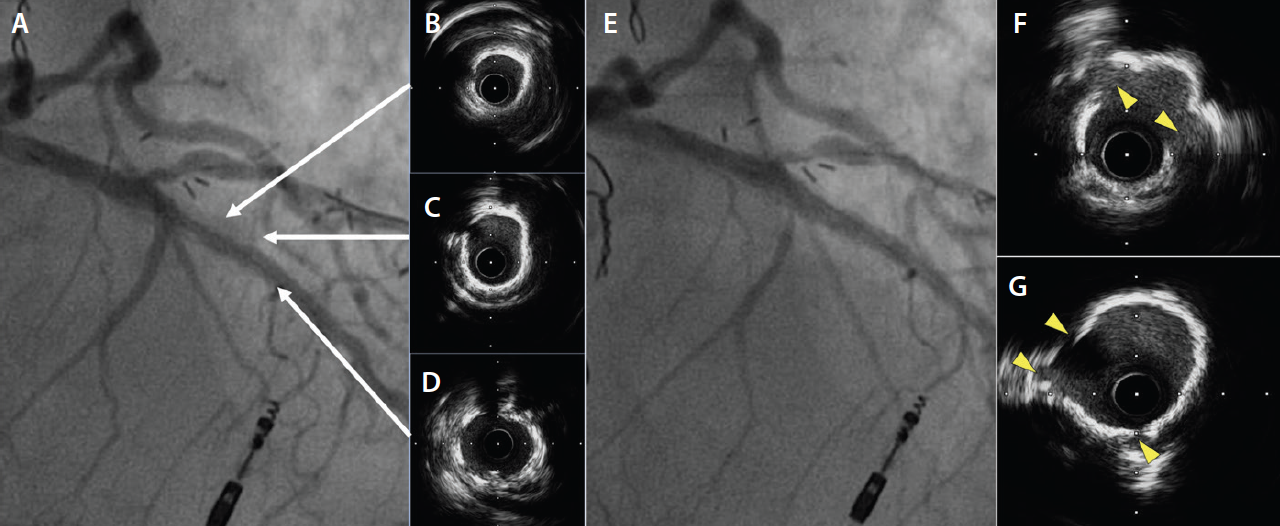 Specialty Balloons: When and How - Cardiac Interventions Today