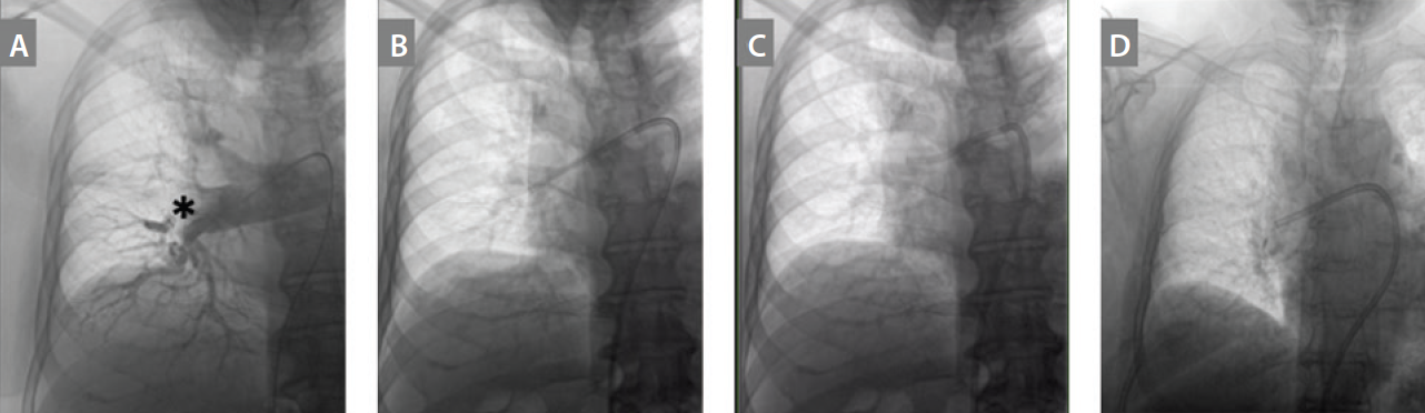Pulmonary Thrombectomy for Acute PE - Cardiac Interventions Today
