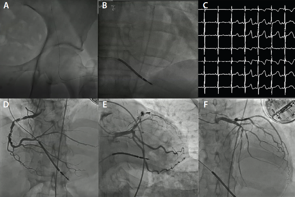 Ultra-Low Contrast Imaging and PCI - Cardiac Interventions Today