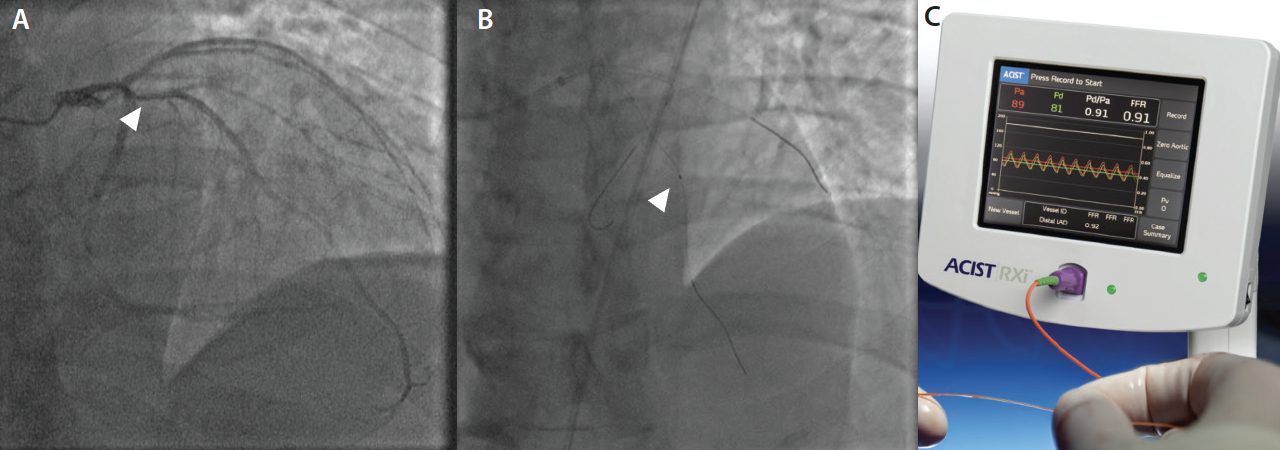 Ultra-Low Contrast Imaging and PCI - Cardiac Interventions Today