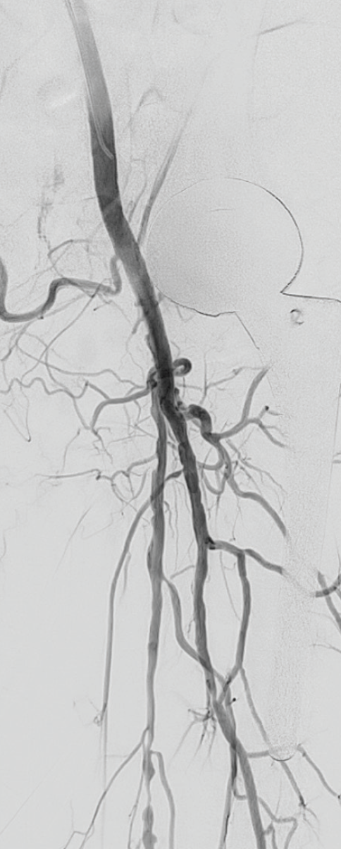 Lower Extremity PAD Utilizing a Radial Approach - Endovascular Today