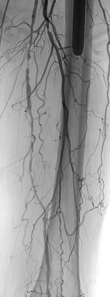 Lower Extremity PAD Utilizing a Radial Approach - Endovascular Today