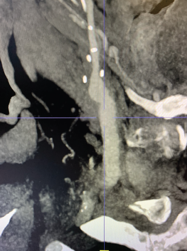 Complex Carotid Disease in a Symptomatic Patient - Endovascular Today