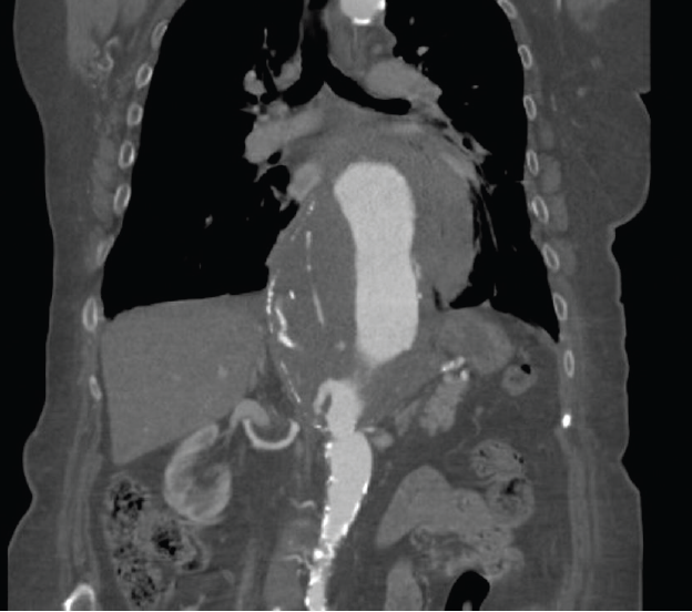 Laser In-Situ Fenestration for Repair of a Symptomatic Extent I ...