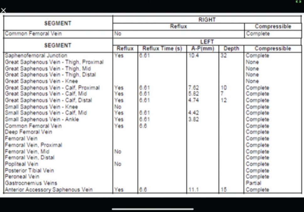Extensive Venous Reflux and Varicose Veins - Endovascular Today