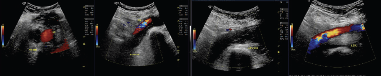 Extensive IVC and Iliac Vein DVT in the Presence of a Permanent IVC ...