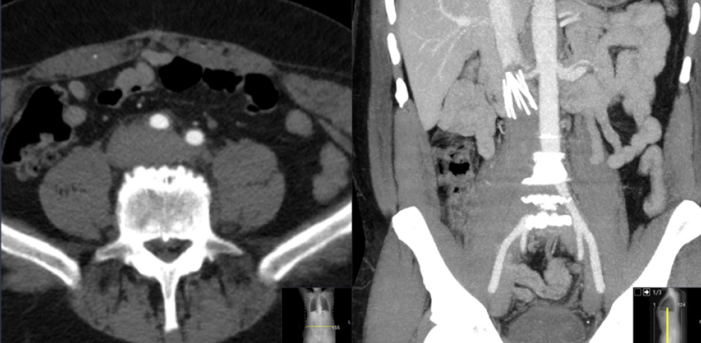 Extensive IVC and Iliac Vein DVT in the Presence of a Permanent IVC ...
