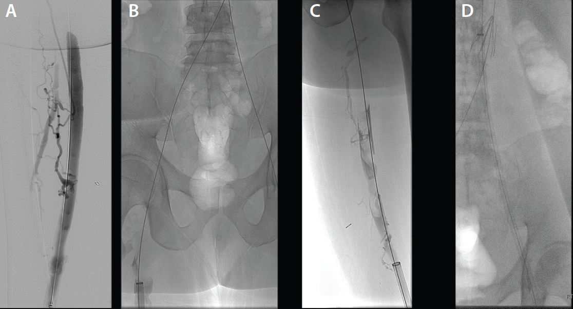 Extensive IVC and Iliac Vein DVT in the Presence of a Permanent IVC ...