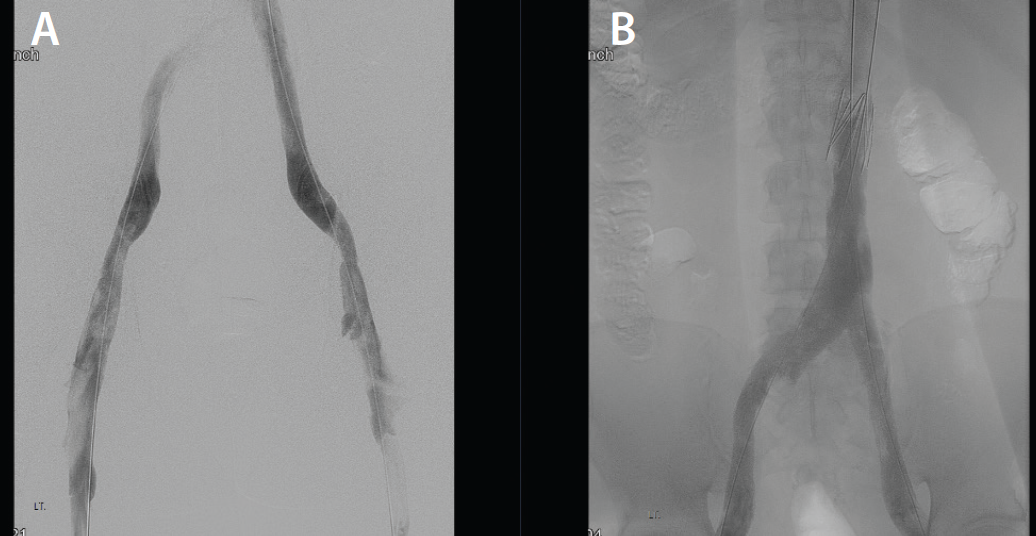 Extensive IVC and Iliac Vein DVT in the Presence of a Permanent IVC ...