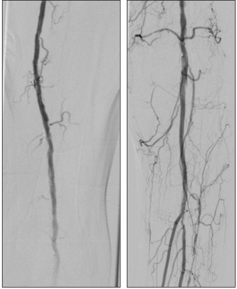 Complex, Multilevel Disease Treated With Serranator Prior to Drug ...