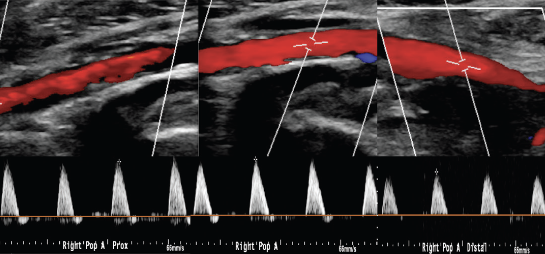 Complex, Multilevel Disease Treated With Serranator Prior to Drug ...