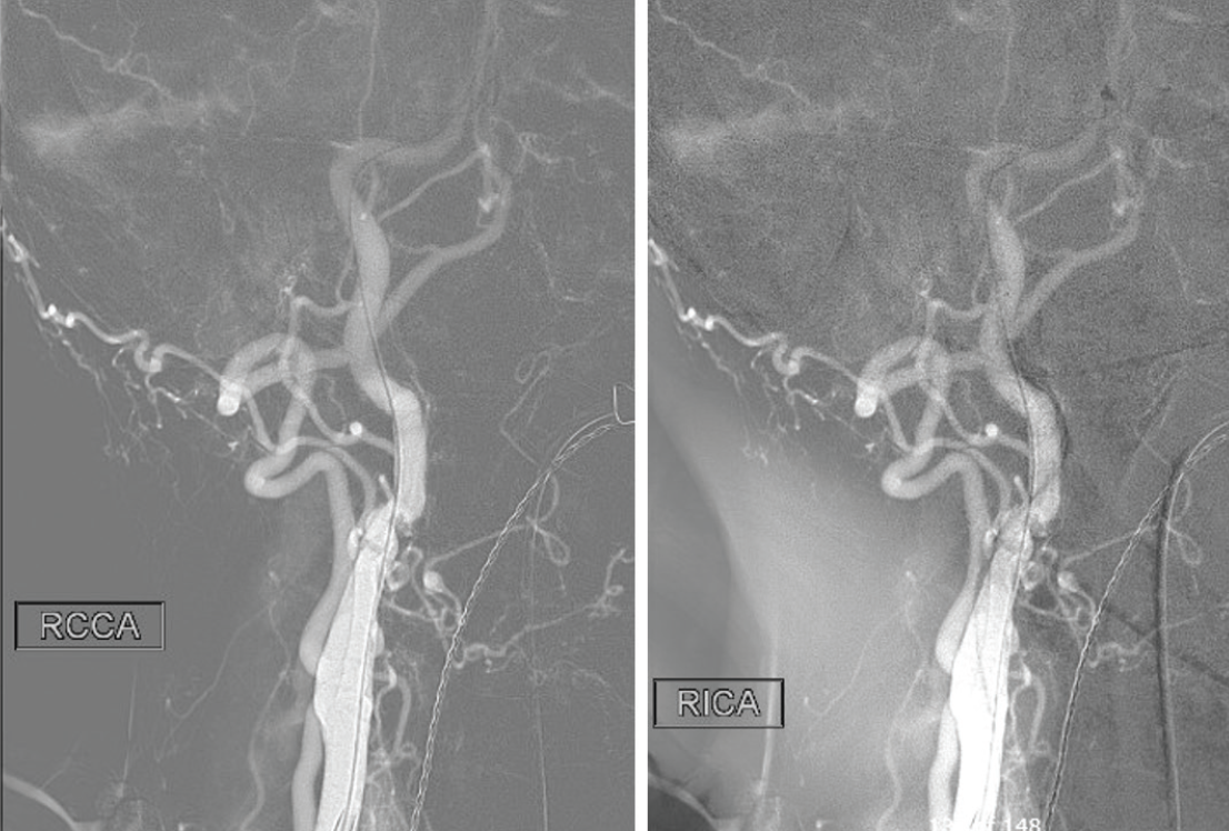 Challenging Mechanical Thrombectomy to Manage an Internal Carotid ...