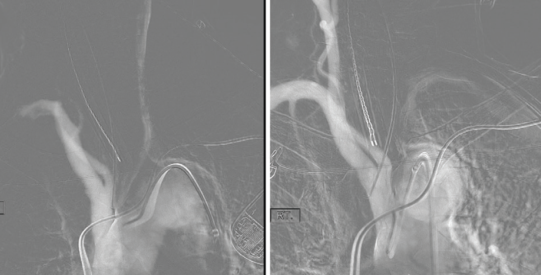 Challenging Mechanical Thrombectomy to Manage an Internal Carotid ...