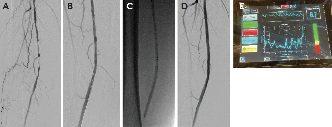 Utility of the FlowMet™ Peripheral Blood Flow Monitoring System for ...