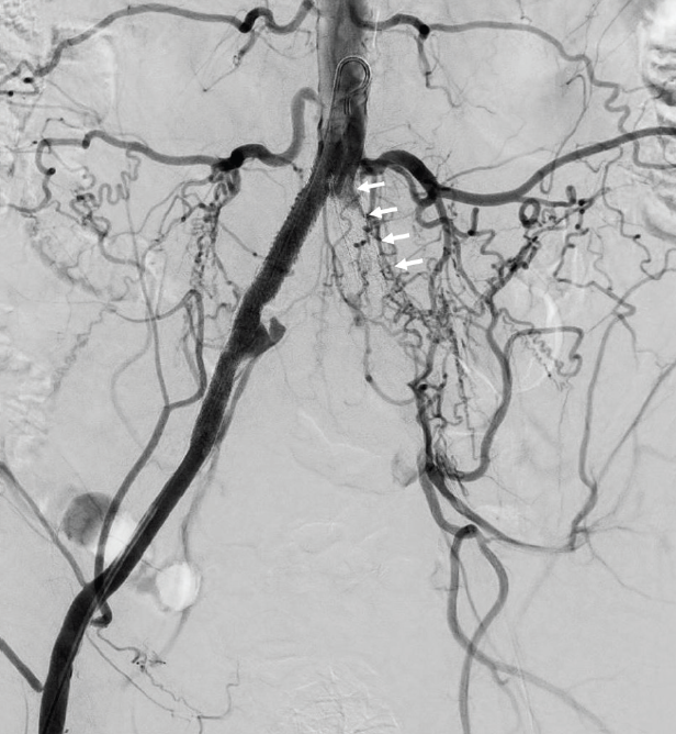 PAD and the SABER™ .035 PTA Catheter - Endovascular Today